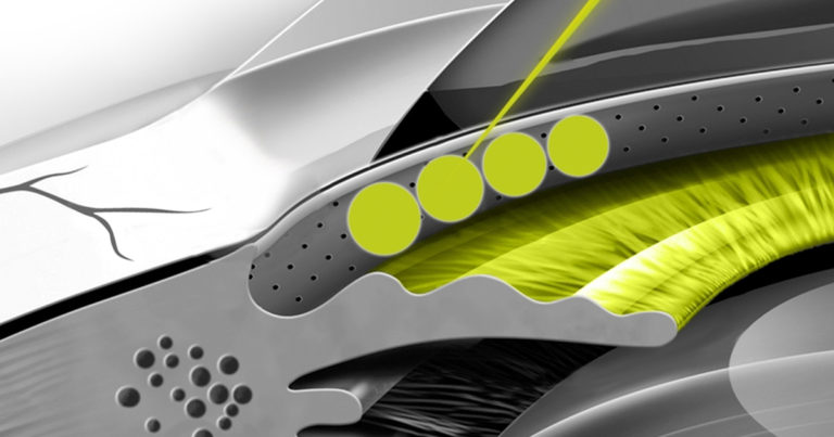 Láser SLT | XR Oftalmología®